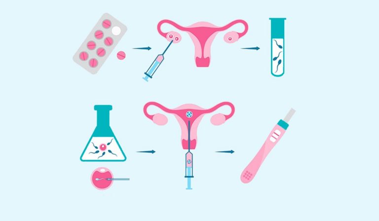 Where Does Fertilization Take Place? - Fallopian Tubes and IVF
