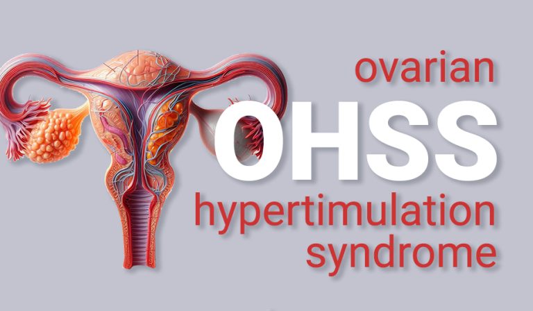 Ovarian Hyperstimulation Syndrome (OHSS) - Symptoms & Risks