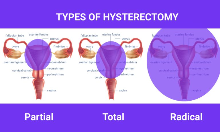 Egg Retrieval After Hysterectomy - #1 More Chance to Have Baby